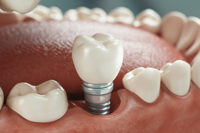 Complete Guide to Dental Implant Costs and Options in India | Lavanya ...